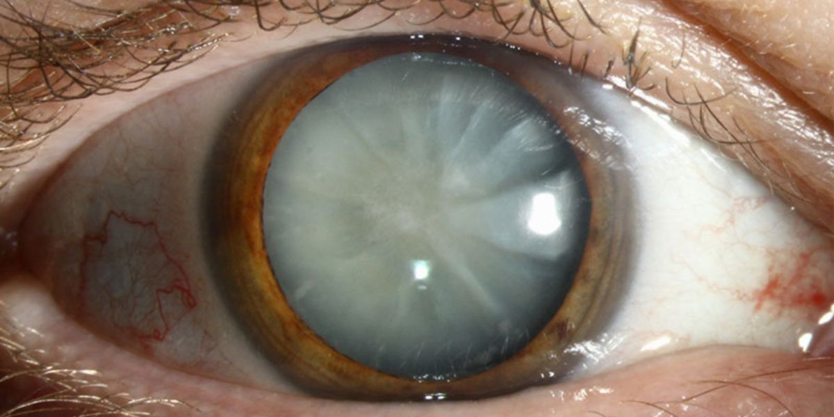 What Are Cataracts